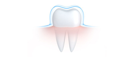 Tooth Enamel Erosion and Restoration