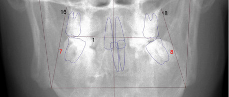 Maxillary expansion or bicuspid extraction: A case study in ...